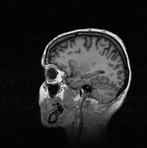 Head MRI Image #2