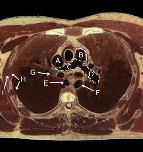 Cross Sectional Anatomy Thorax